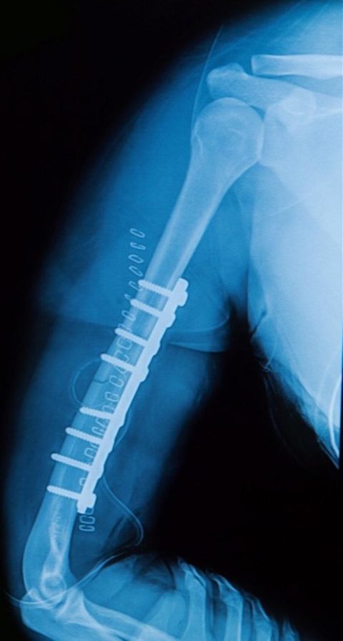 When Does a Rod Help After a Fracture? - Tadje Ortho